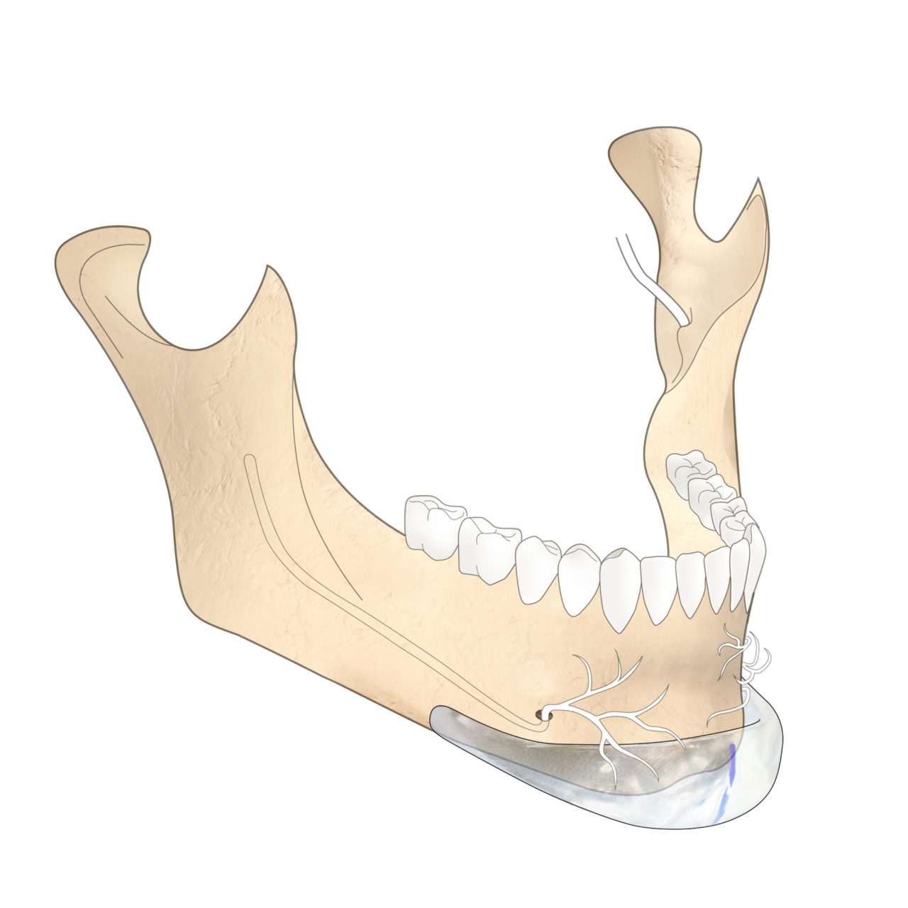 Alloplastische implantaten - Johan Jansma
